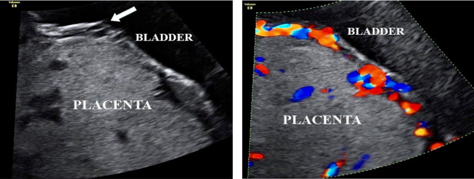 Placenta Accreta Spectrum - FMF Courses
