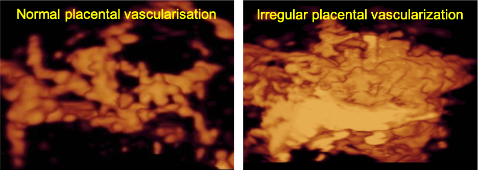 Placenta Accreta Spectrum - FMF Courses