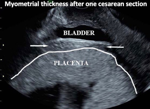 Placenta Accreta Spectrum - FMF Courses
