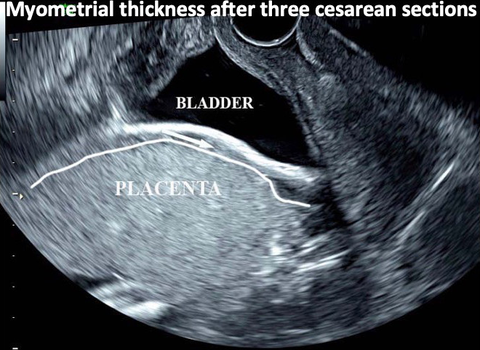 Placenta Accreta Spectrum - FMF Courses
