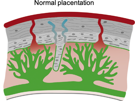 Placenta Accreta Spectrum - FMF Courses