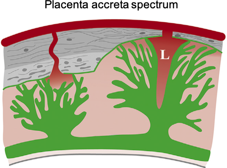Placenta Accreta Spectrum - FMF Courses